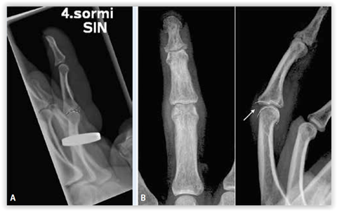 Sormimurtumien konservatiivinen hoito