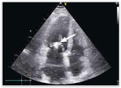 Keski-ikäisen naisen hengenahdistusoire