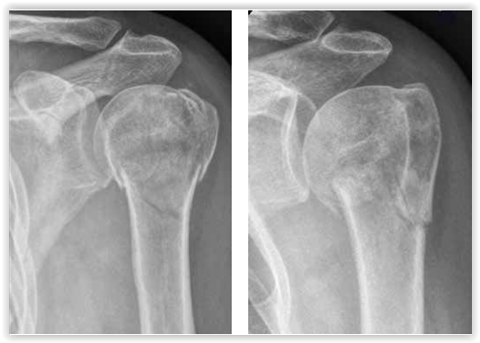 Ikääntyvien olkaluun yläosan murtuman hoito