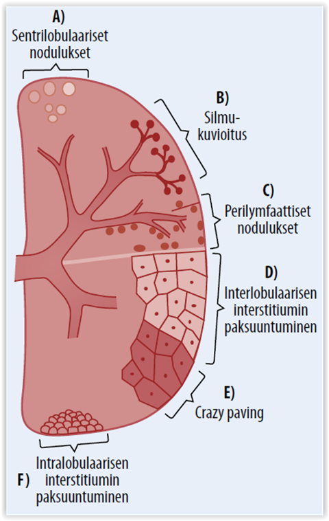 Keuhkojen ohutleiketietokonetomografian käyttöaiheet ja diagnostiikka