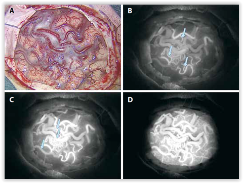 Aivojen valtimo-laskimoepämuodostumat