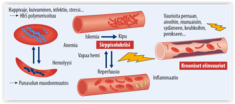 Sirppisolukriisit - kun selkäkipu ei olekaan noidannuoli tai kuume flunssaa