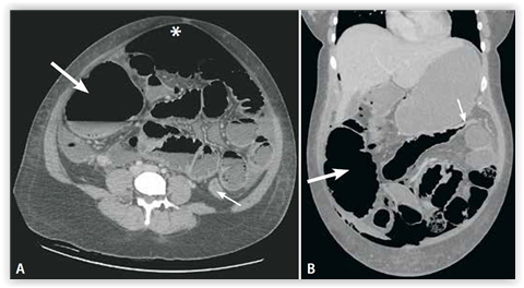 Akuutti paksusuolen pseudo-obstruktio - keisarileikkauksen harvinainen ...