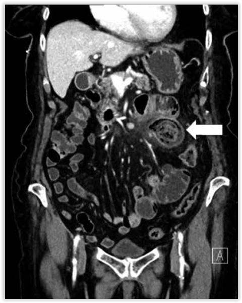 Vanhuksen ohutsuolitukos