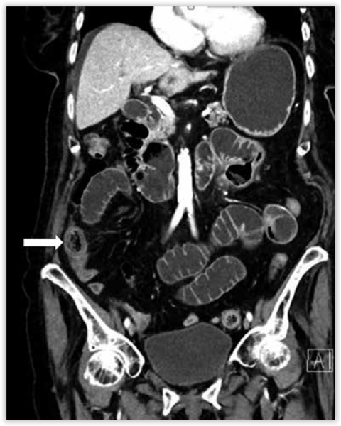 Vanhuksen ohutsuolitukos