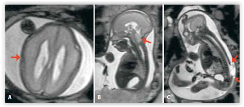 Sikiön magneettikuvaus