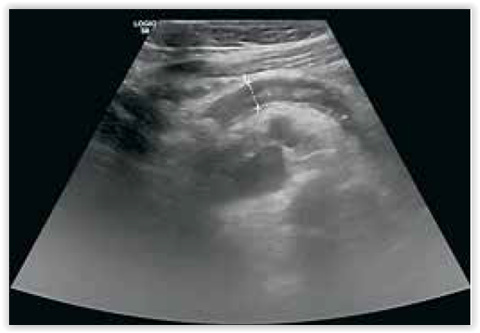 Lapsen äkillinen vatsakipu