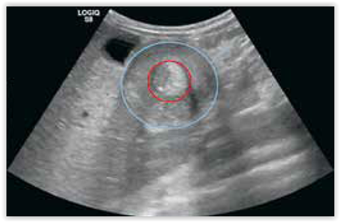 Lapsen äkillinen vatsakipu