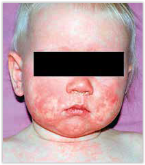 Tuhkarokko - unohtuva uhka