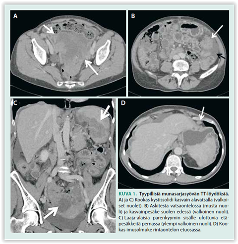 Munasarjasyövän leikkaushoidon suunnittelu
