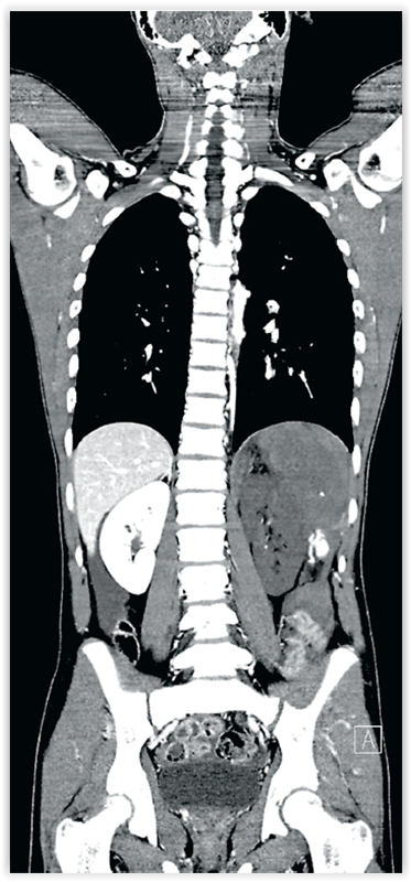 »Revennyt perna ja pimennyt munuainen»