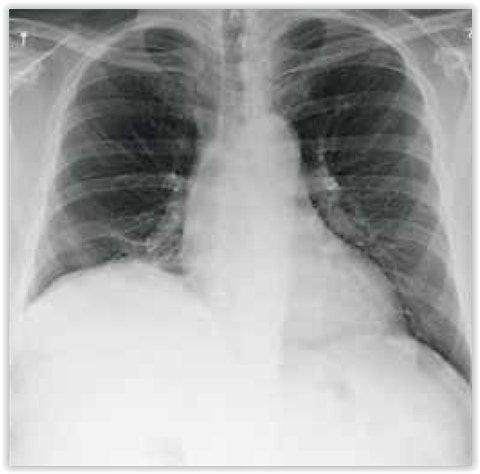 Hengenahdistus ja pallean kohoasento