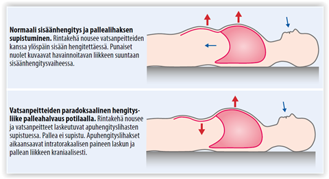 Hengenahdistus ja pallean kohoasento