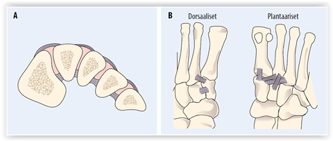 Jalkaterän keskiosan alidiagnosoidut vammat