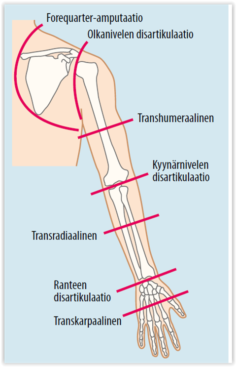 Kehittyvä kirurgia ja proteesiteknologia yläraaja-amputaatioissa