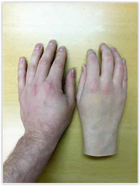 Kehittyvä kirurgia ja proteesiteknologia yläraaja-amputaatioissa