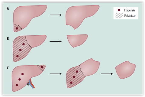 Maksaetäpesäkkeiden leikkaushoito - missä menevät rajat?