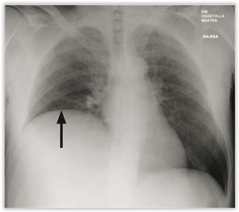 Spasmaavat sepelvaltimot ja kohoava palleankaari