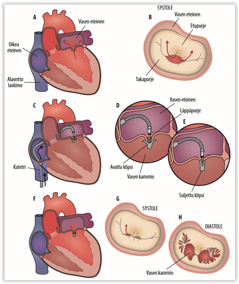 Hiippaläpän vuodon katetrihoidosta viimein näyttöä