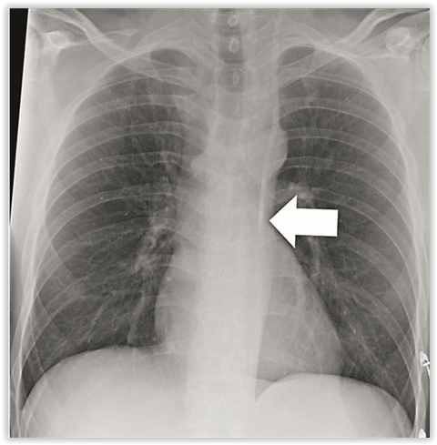 Putket ja piuhat keuhkokuvassa
