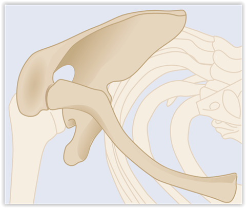 Olkalisäke-solisluunivelen sijoiltaanmenon hoitolinjat