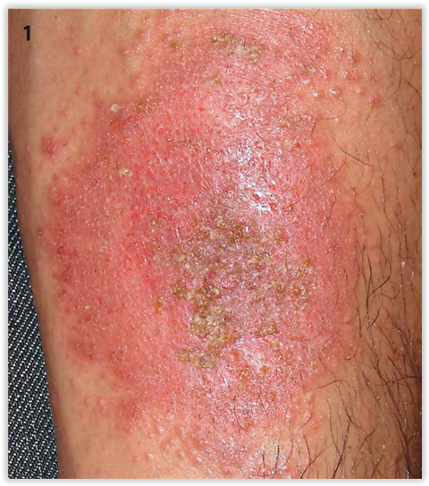 Ekseemat yleislääkärin vastaanotolla