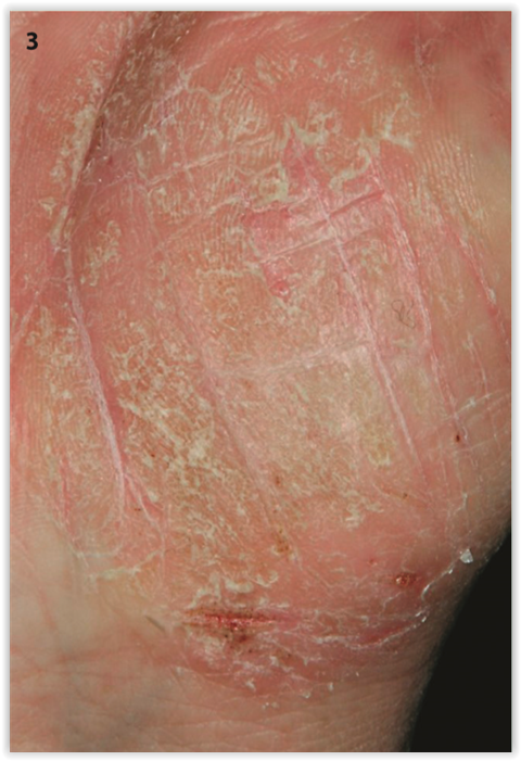 Ekseemat yleislääkärin vastaanotolla