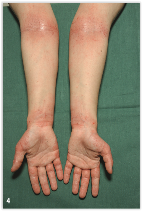 Ekseemat yleislääkärin vastaanotolla