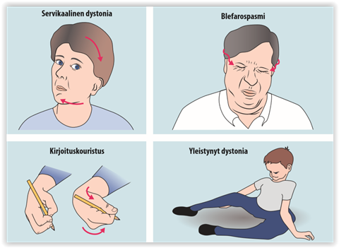 Dystonian patofysiologia ja hoito