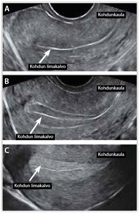 Hedelmällisessä iässä olevien naisten vuotohäiriöiden polikliininen ...