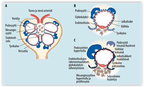 Miten diabeettinen munuaistauti syntyy?
