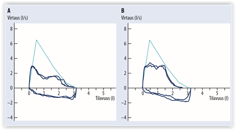 Molemminpuolisen äänihuulihalvauksen botuliinitoksiinihoito