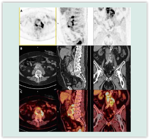 Vatsa-aortan infektiot
