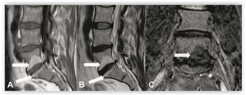 Välilevyrappeumaan liittyvät nikaman luuydinmuutokset eli Modic ...