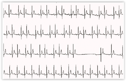 EKG:n pitkäaikaisrekisteröinti
