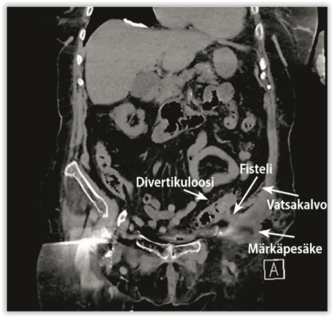 Divertikkelin puhkeamisen aiheuttama nivusalueen märkäpesäke