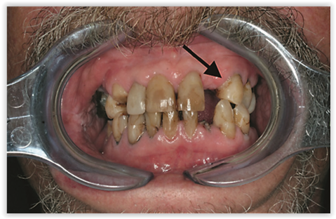 Aivovaltimoaneurysmat ja suun terveys