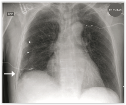 Kylkiluiden sarjamurtumat