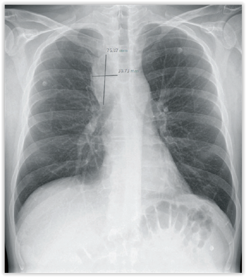 Aikuisen keuhkojen ulkopuolinen tuberkuloosi - diagnostinen haaste