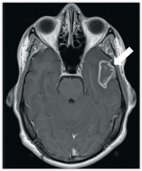 Aikuisen keuhkojen ulkopuolinen tuberkuloosi - diagnostinen haaste