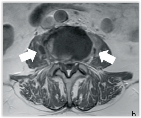 Aikuisen keuhkojen ulkopuolinen tuberkuloosi - diagnostinen haaste