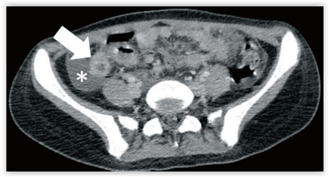 Aikuisen keuhkojen ulkopuolinen tuberkuloosi - diagnostinen haaste