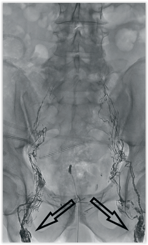 Hoitoresistentti kyloaskites leikkauksen jälkeen - ruokavalio, lääke ...