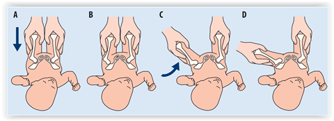 Synnynnäinen lonkkaluksaatio