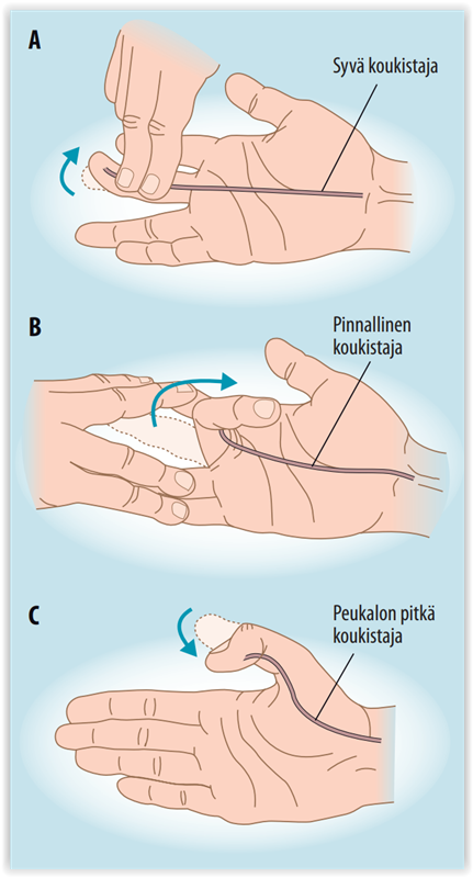Sormien jännevammat