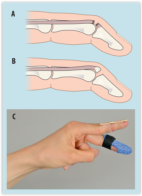Sormien jännevammat