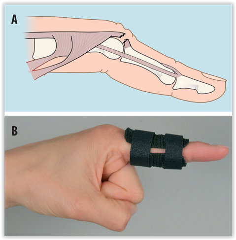 Sormien jännevammat