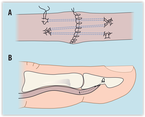 Sormien jännevammat