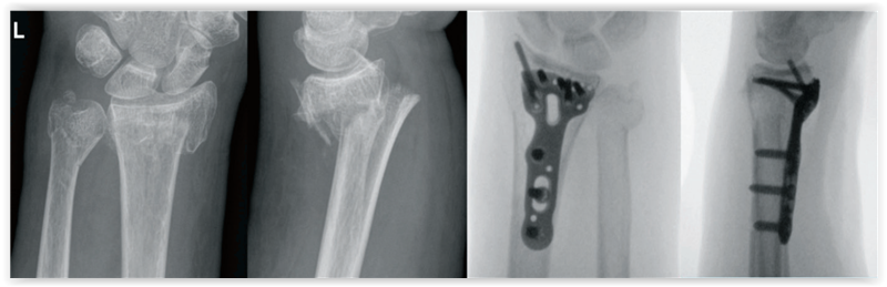 Ikääntyvän potilaan värttinäluun alaosan murtuman hoito - kohti ...