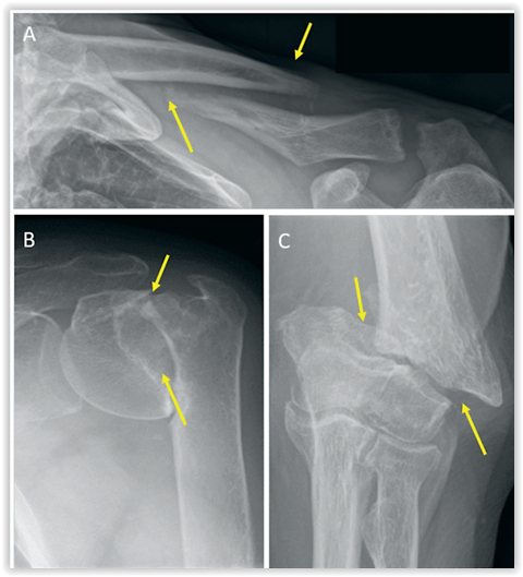 Kun luunmurtuma ei parane